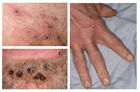 Monkeypox, explained: Symptoms, vaccine, treatment options and more