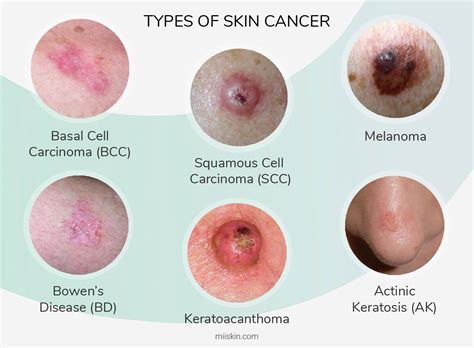 A review on recent developments in cancer detection using Machine ...