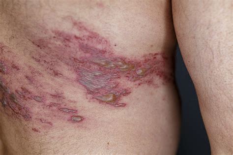 Bệnh zona không điều trị đúng nguy hiểm thế nào? | Trung Tâm Y Tế Thành ...