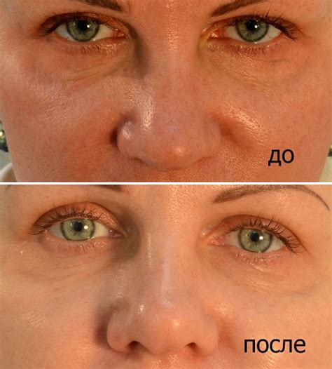 Фото до и после чистки лица у косметолога в Краснодаре - Фото работ