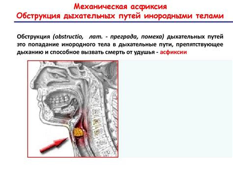 Первая помощь при обструкции верхних дыхательных путей - презентация онлайн