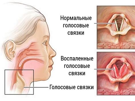 Рак голосовых связок - лечение в Израиле : Armedical