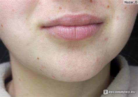 Маска для лица ARAVIA Post-Acne Balance Mask рассасывающая с ...