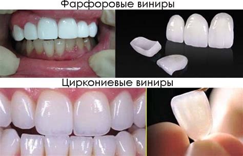 Виниры на зубы. Что это такое, фото до и после, плюсы и минусы, как ...