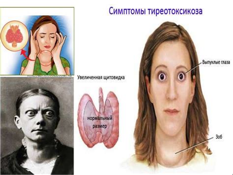 Тиреотоксикоз - презентация онлайн