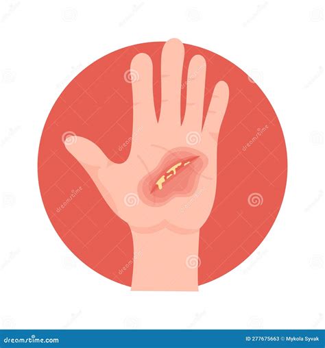 Signos De Infección En La Herida De La Mano Ilustración del Vector - Ilustración de enfermedad ...