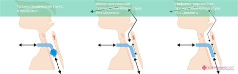Что такое трахеостома: её виды и особенности