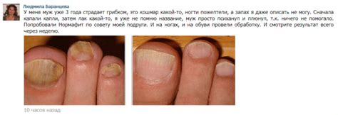 Нормафит от грибка – отзывы, цена, инструкция
