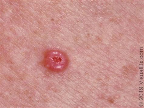 Carcinoma de células basales, todo sobre este tipo de cáncer