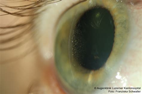 Uveitis anterior | Ophtha.ch