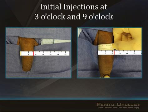 GIRTHMAX℠ Procedure for Penile Enhancement - Perito Urology