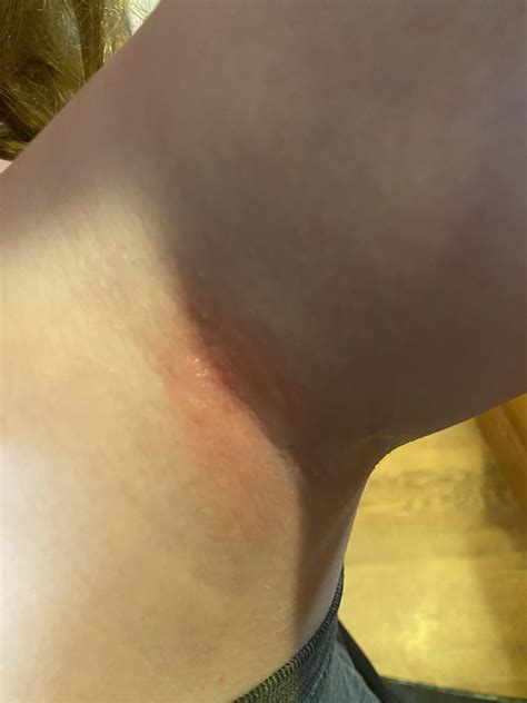 Underarm rash : r/DermatologyQuestions