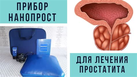 Нанопрост: цена прибора, отзывы женщин о лечении