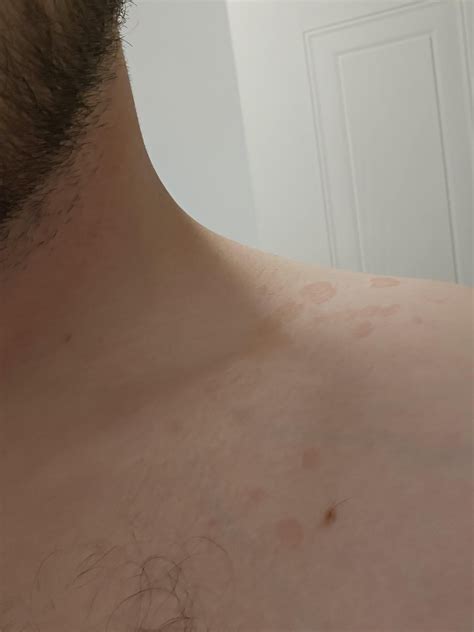 Strange rash : r/DermatologyQuestions