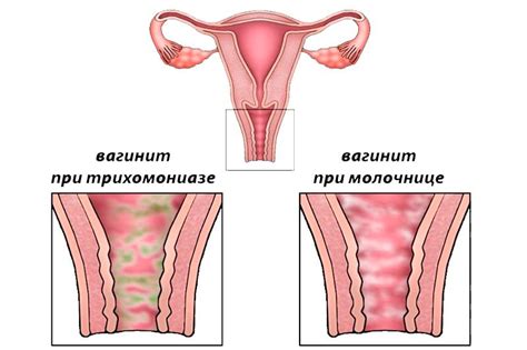 Вагинит: причины, симптомы, диагностика и лечение