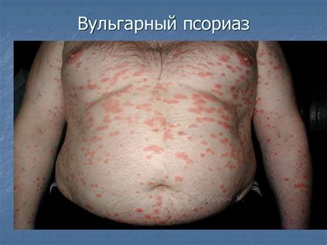 Псориаз, КПЛ - online presentation
