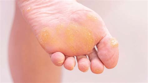 Corns and Calluses: Causes, Symptoms and Treatment | Podiatry