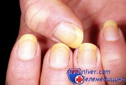 Как избавиться от желтизны ногтей? Причины желтого оттенка ногтей