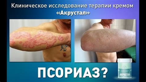 "Акрустал" - если псориаз! - YouTube