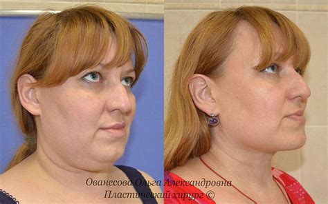 Липосакция подбородка, отзывы * реабилитация, фото до и после лазерной ...