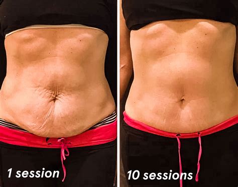 Body Sculpting Treatments in Allen | Body Sculpt Session | (972) 630-4257