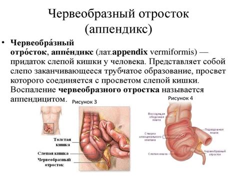 Аппендэктомия. Острый аппендицит - презентация онлайн