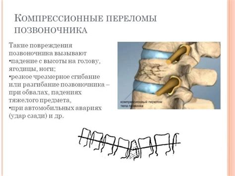 Компрессионный перелом позвоночника: что это такое, лечение и последствия