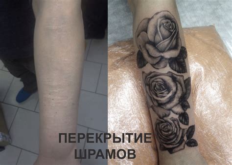 Перекрытие шрамов на руке, салон Olimp (ID:17618)