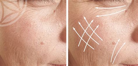 REJUVENATION WITH polylactic acid PLLA – Olidia® - Art Of Beauty - Art ...