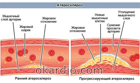 Атеросклероз сосудов головного мозга причины